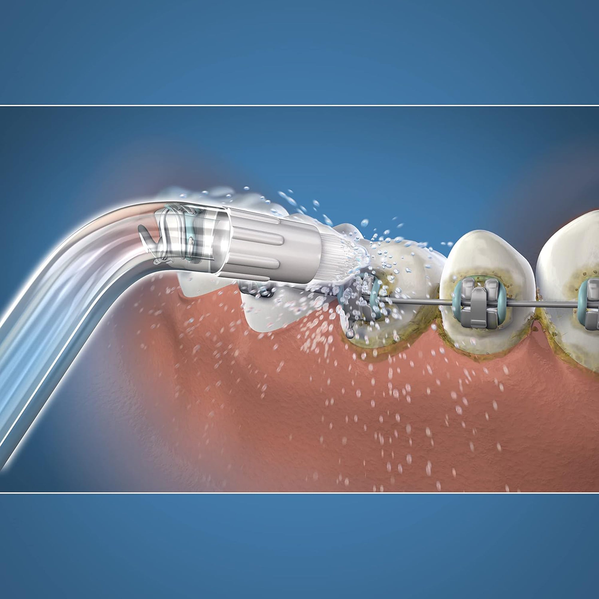 Waterpik Orthodontic Water Flosser Tip – Ultramed